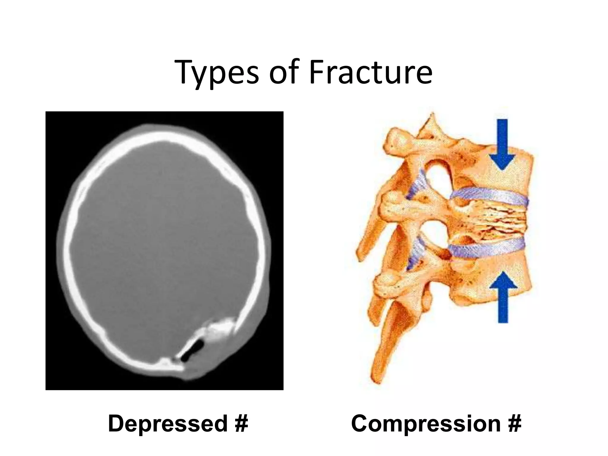 General principles of fractures | PPTX