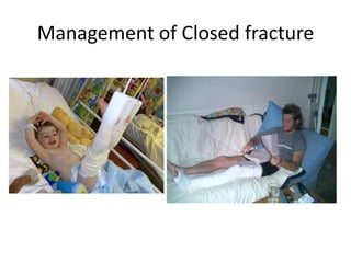 General principles of fractures | PPTX