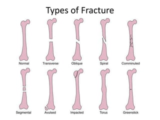 General principles of fractures | PPTX