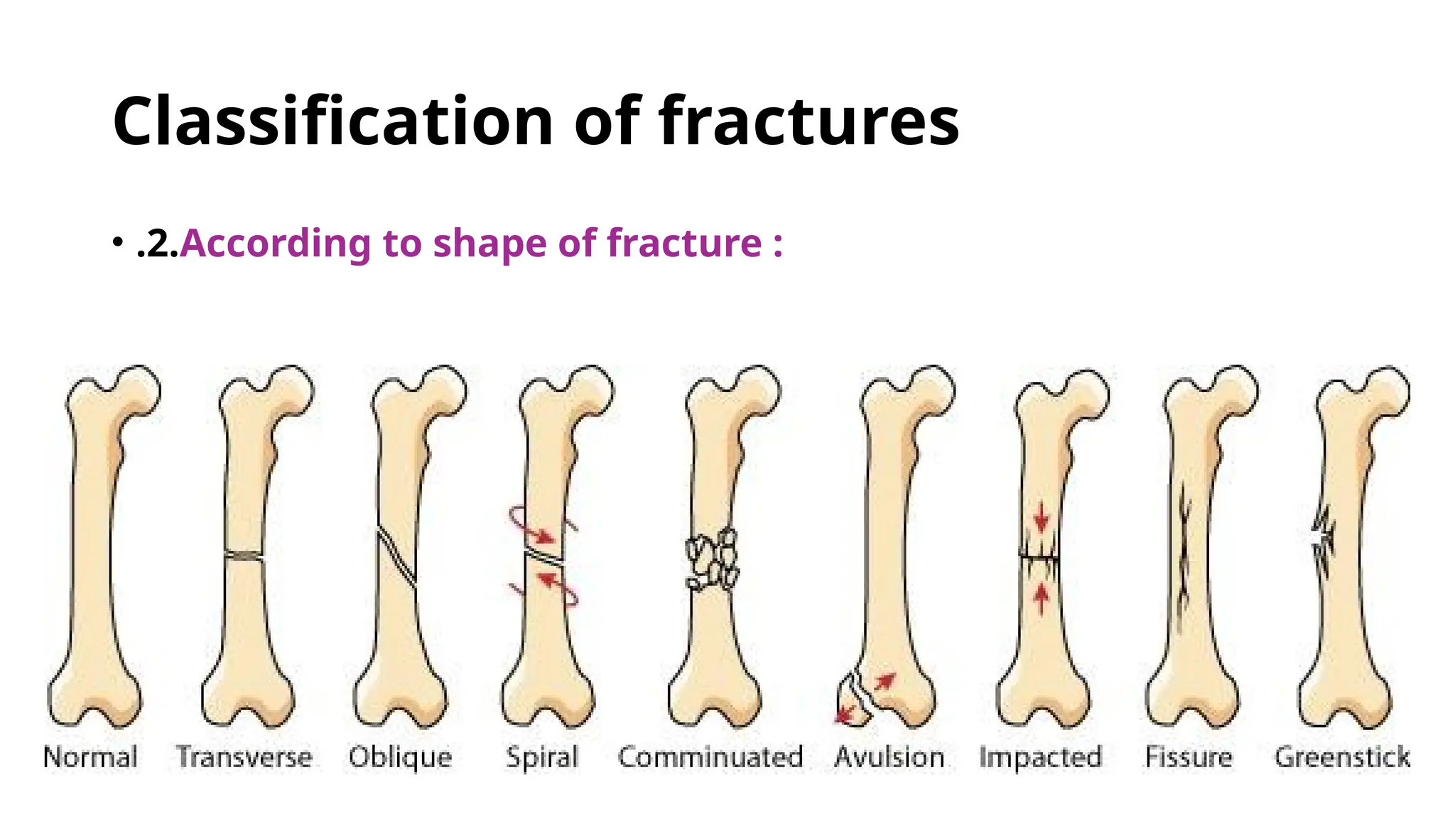 general. principles of fractures.pptx