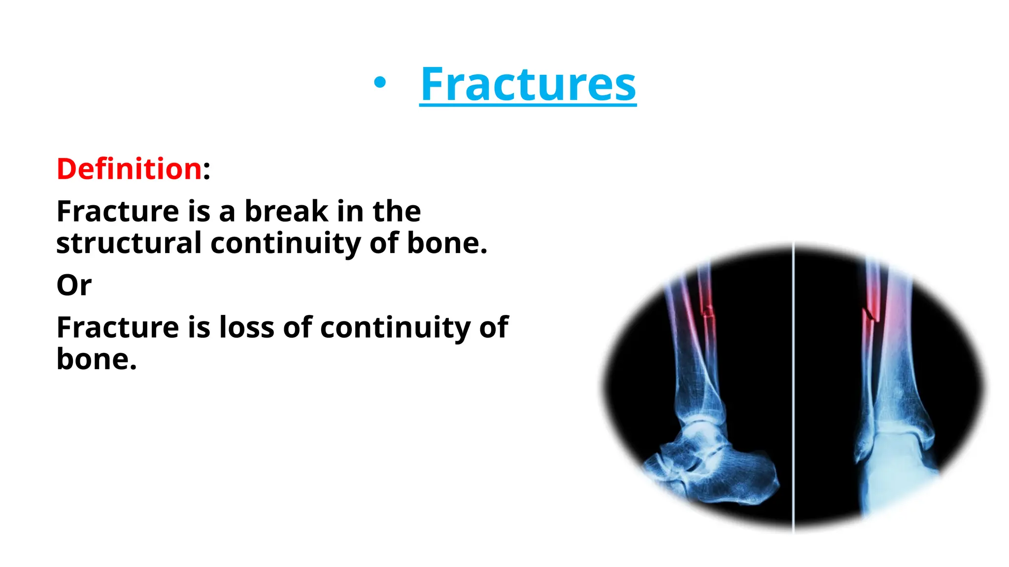 general. principles of fractures.pptx