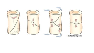 general. principles of fractures.pptx