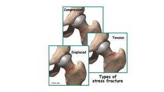 general. principles of fractures.pptx
