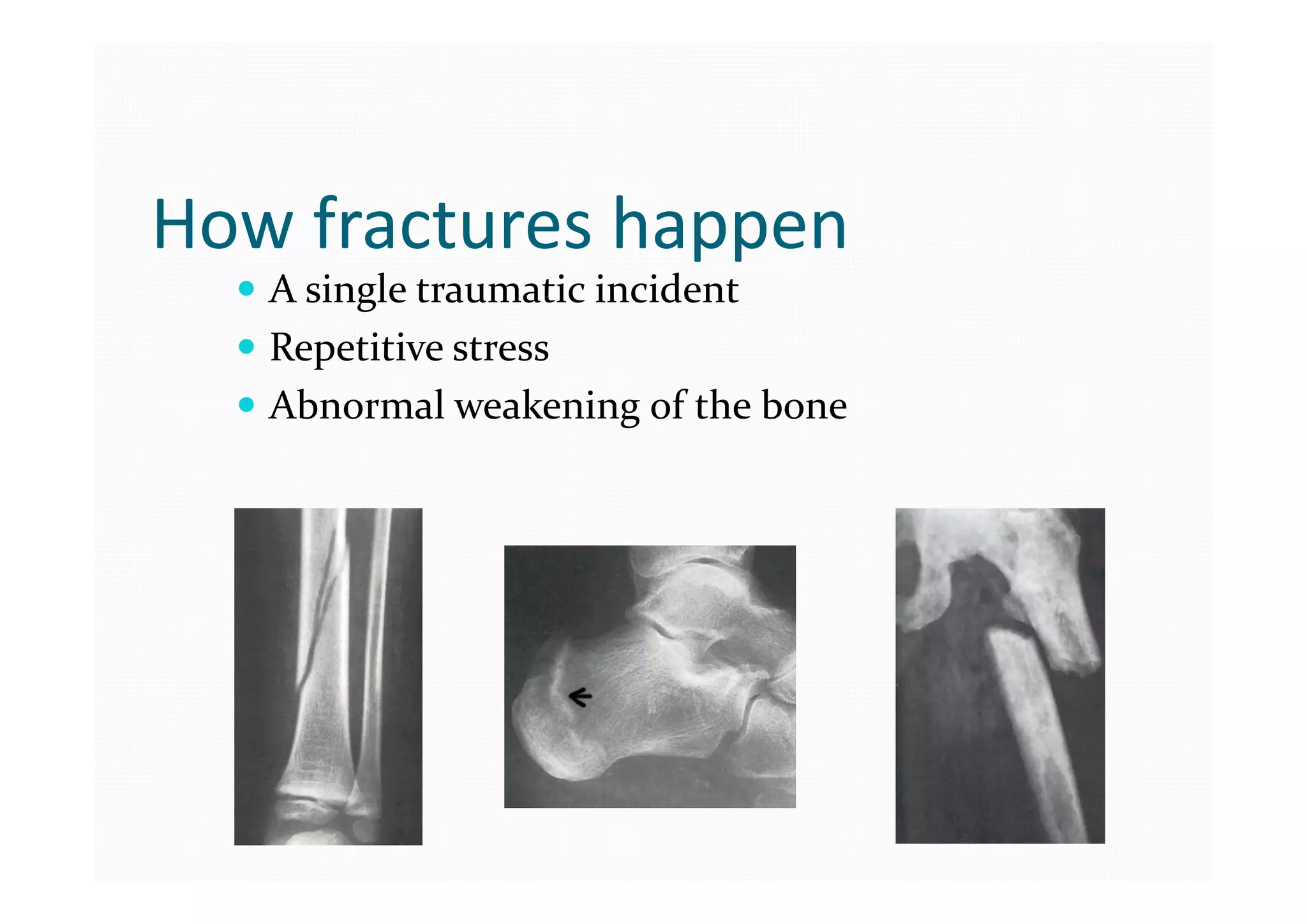 General principles of fractures treatment 1.pdf