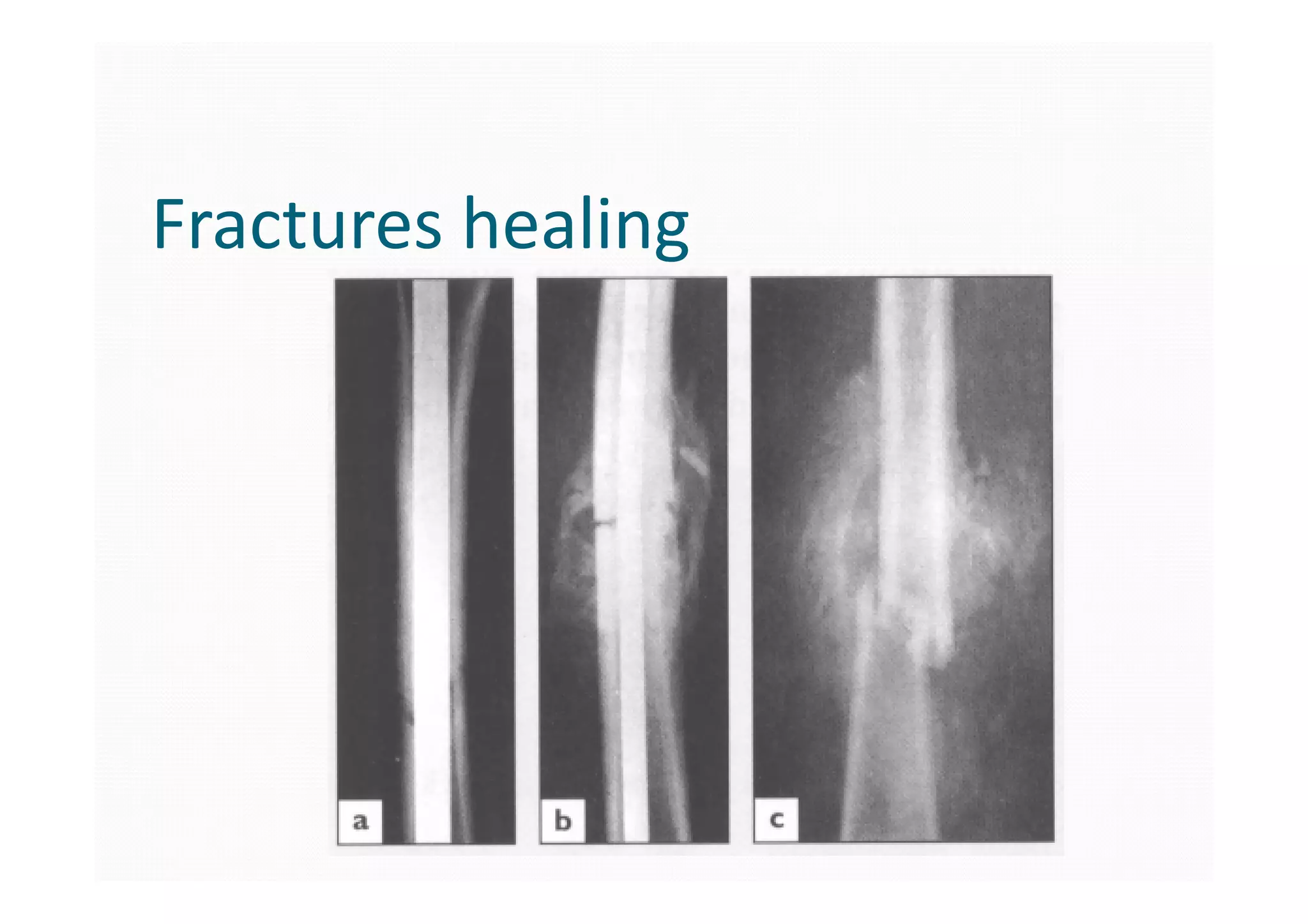General principles of fractures treatment 1.pdf