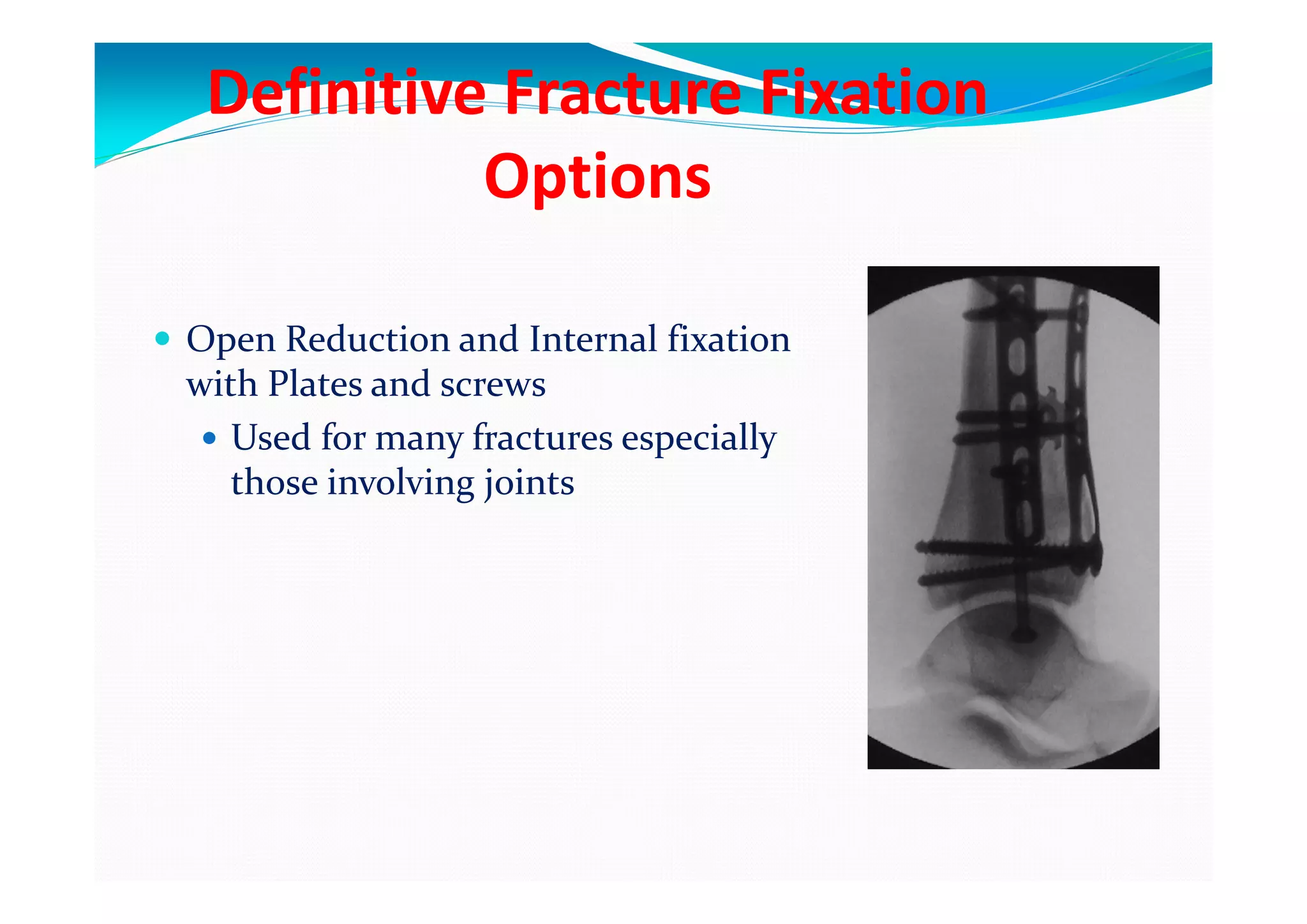 General principles of fractures treatment 1.pdf