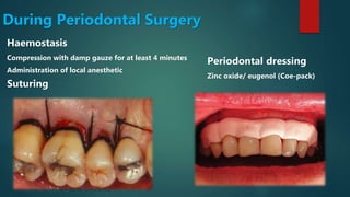 General principles of periodontal surgery | PPT
