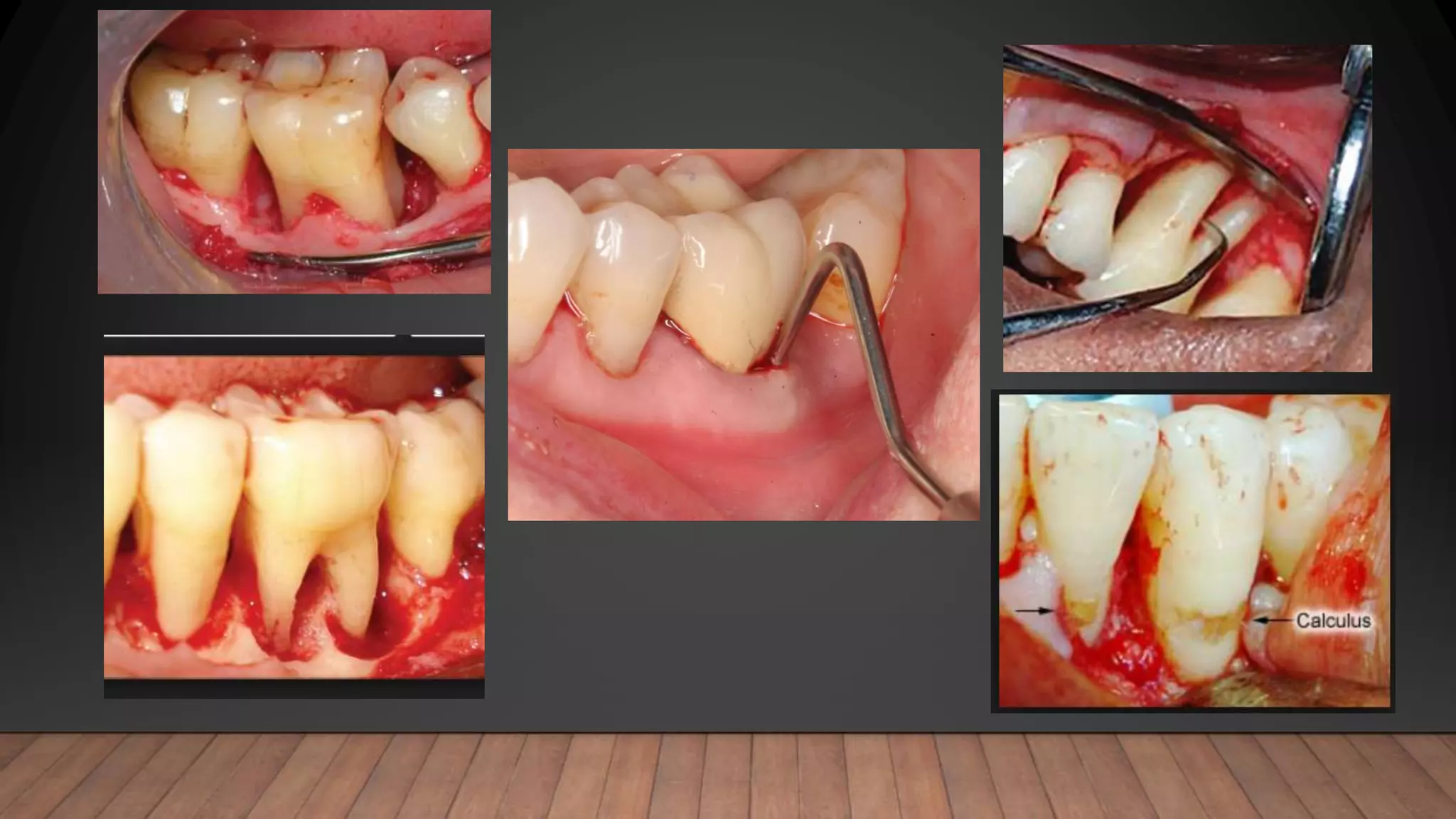General principles of periodontal surgery | PPTX