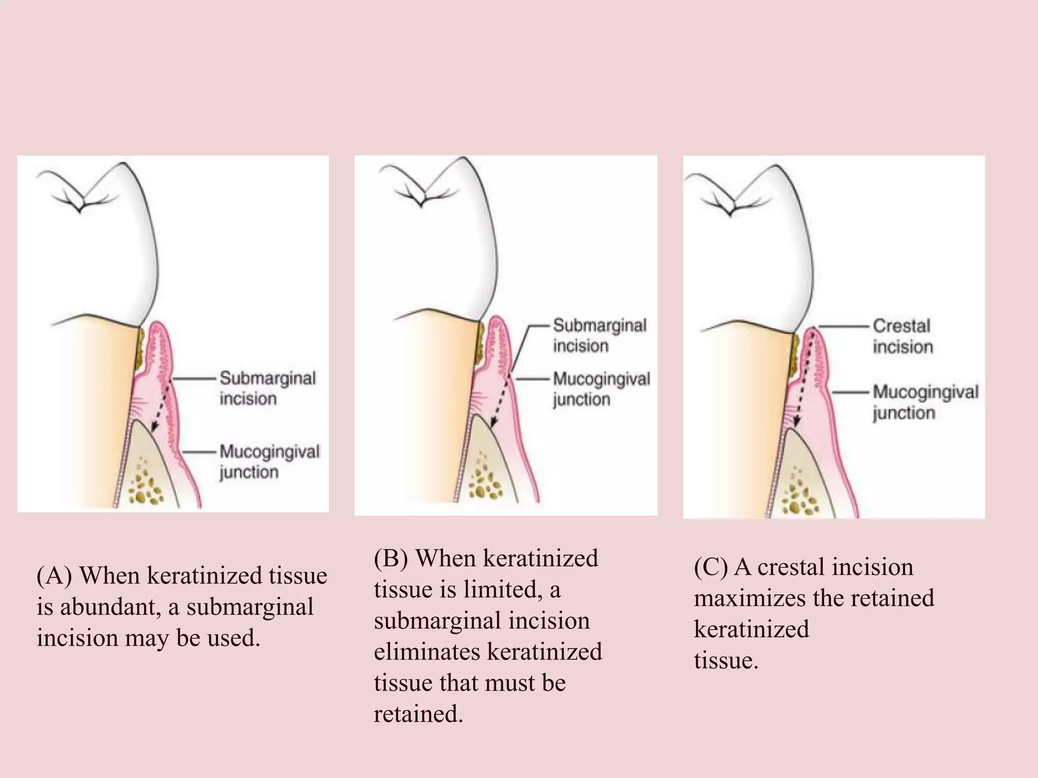 General principles of periodontal surgery | PPTX