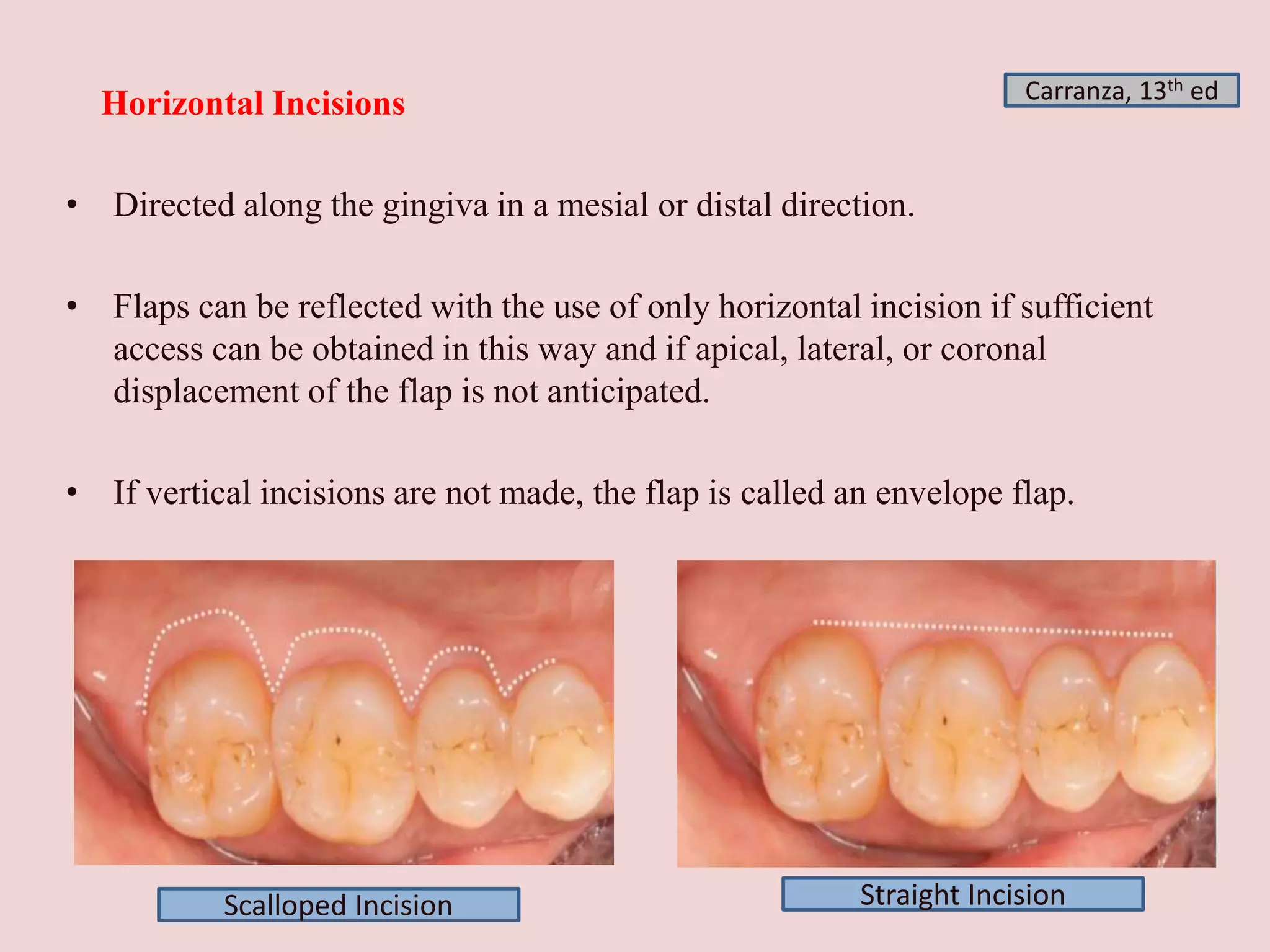 General principles of periodontal surgery | PPTX