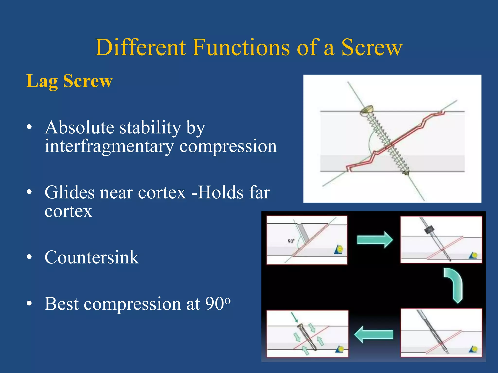 Plating principles in Orthopaedics | PPTX