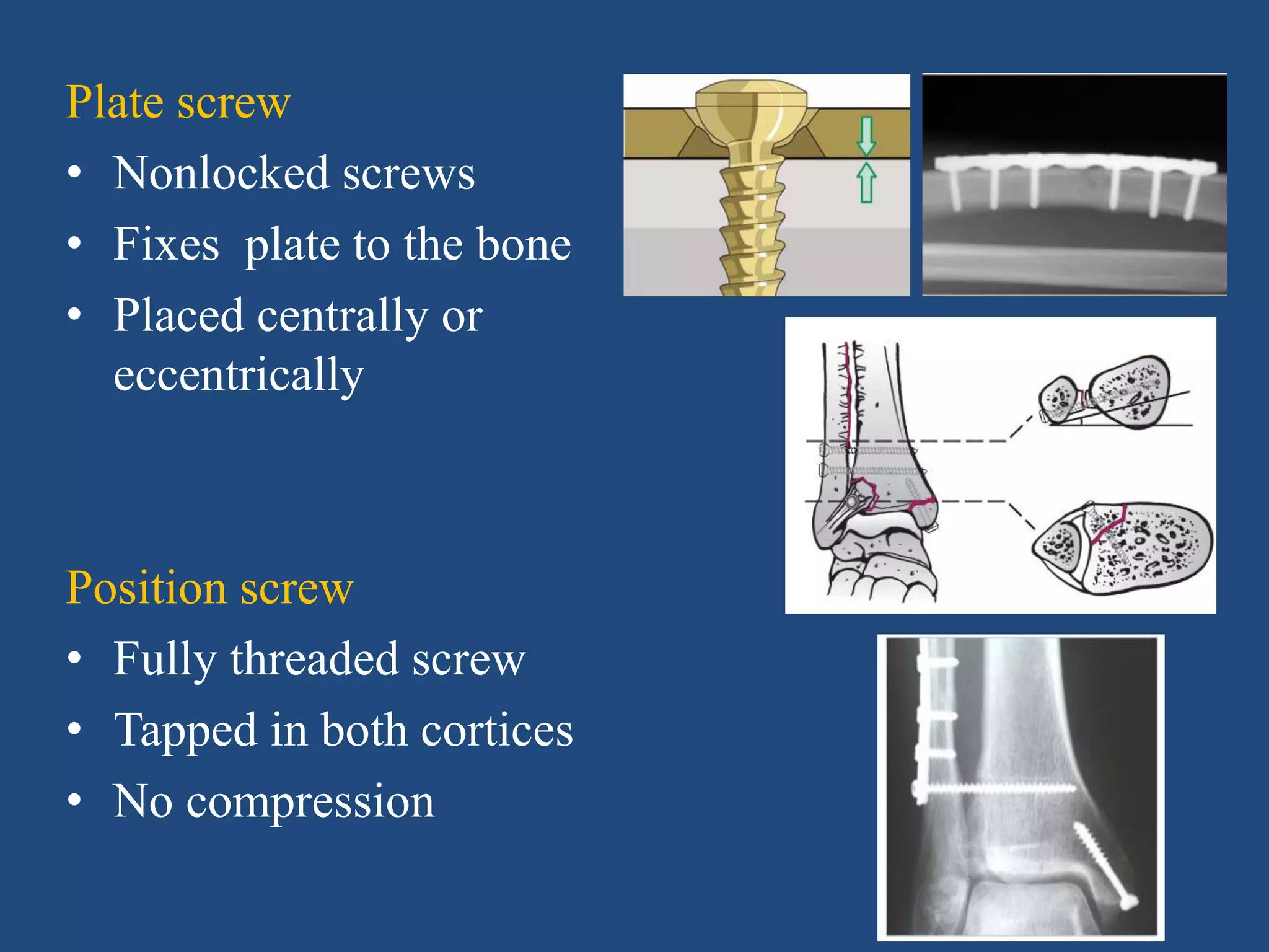 Plating principles in Orthopaedics | PPTX
