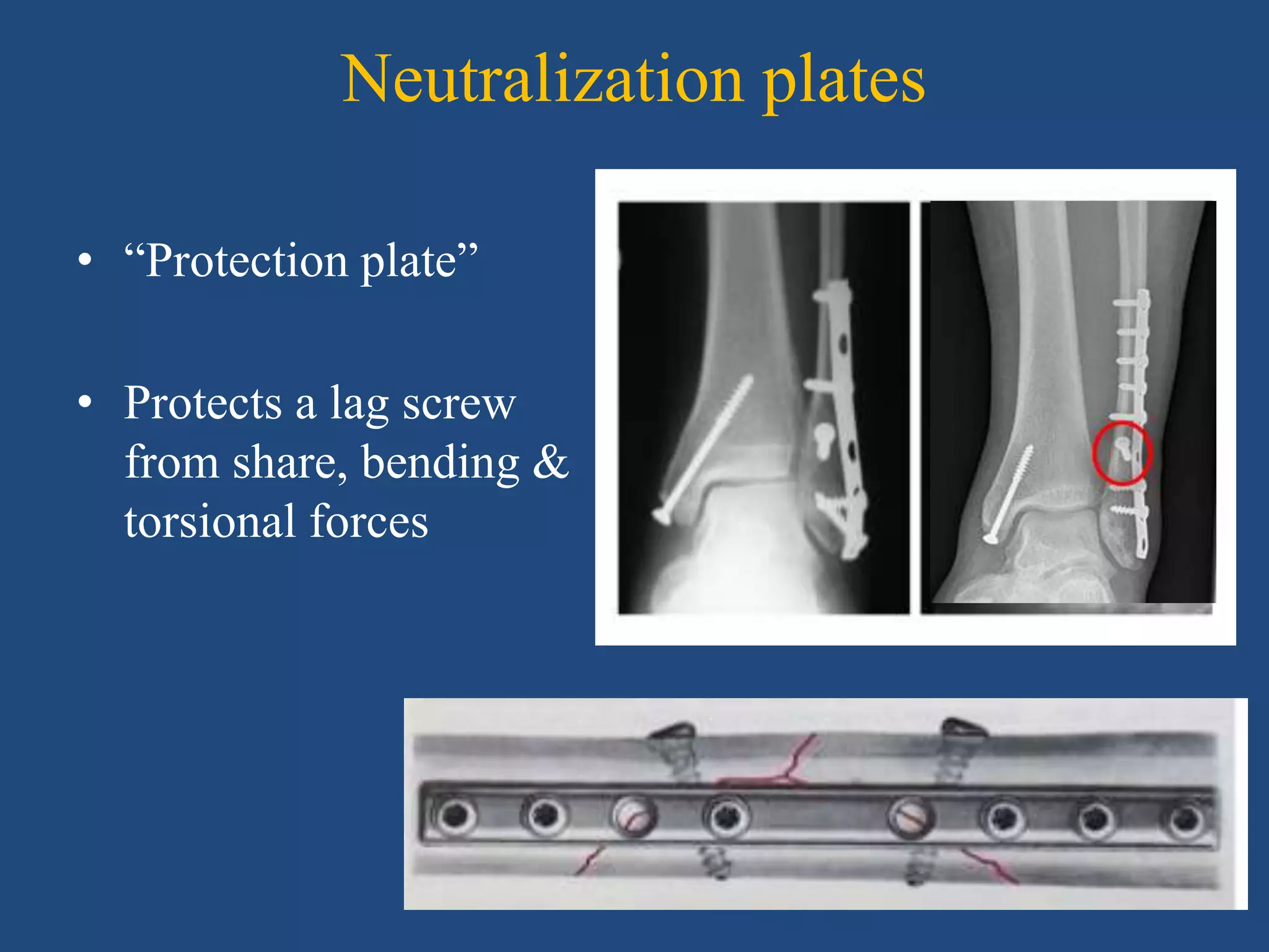 Plating principles in Orthopaedics | PPTX