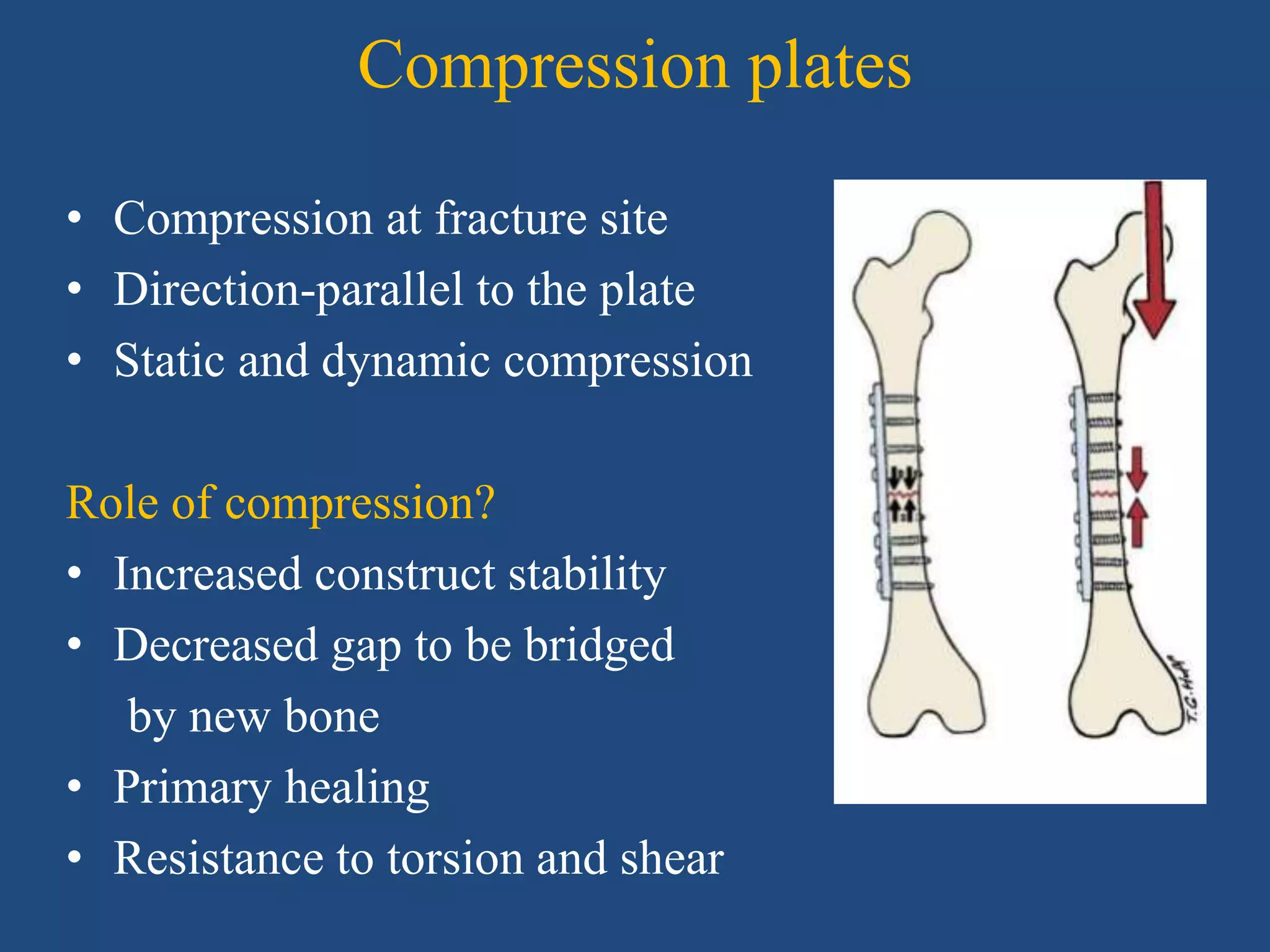 Plating principles in Orthopaedics | PPTX