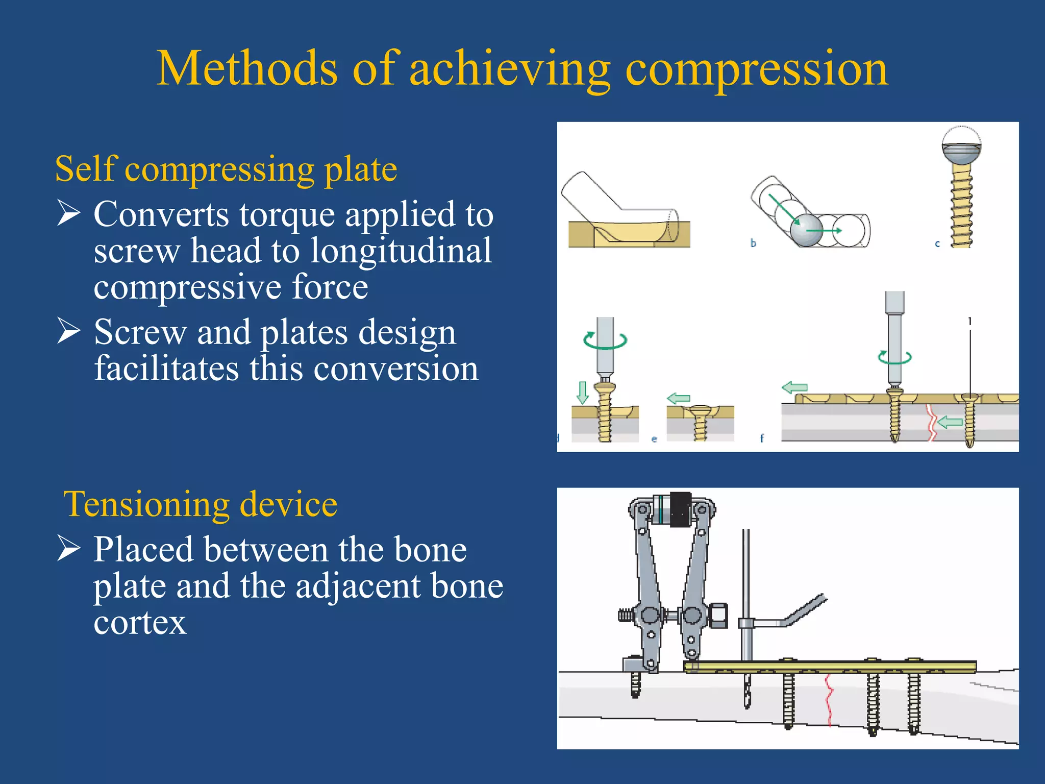 Plating principles in Orthopaedics | PPTX