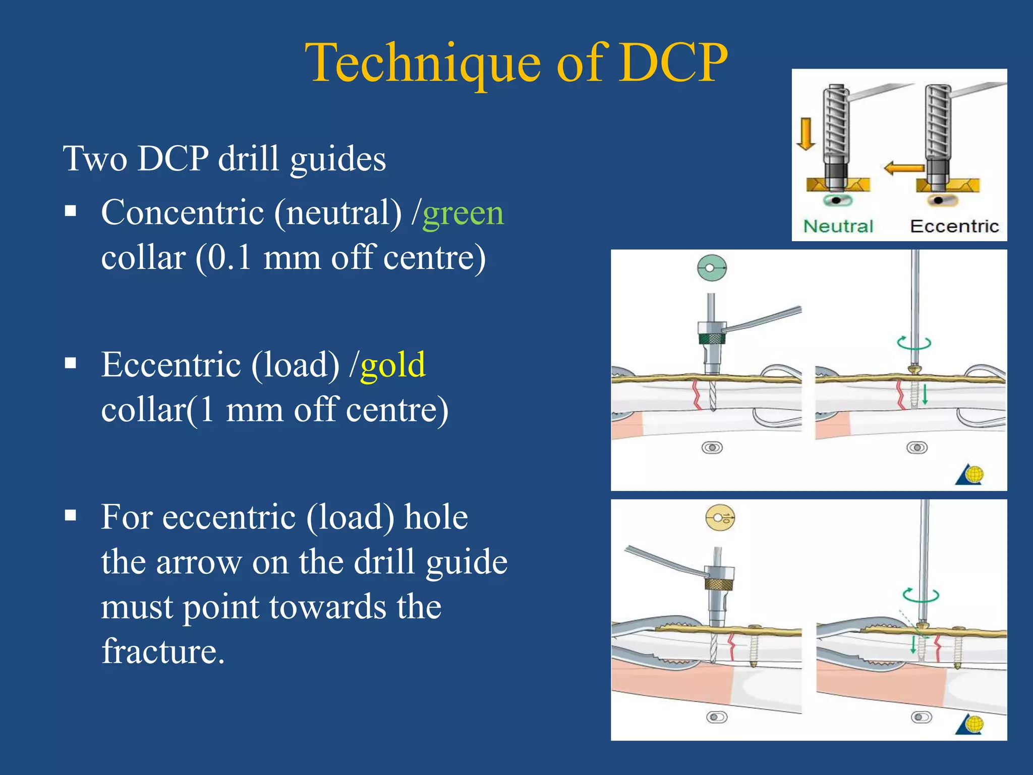 Plating principles in Orthopaedics | PPTX