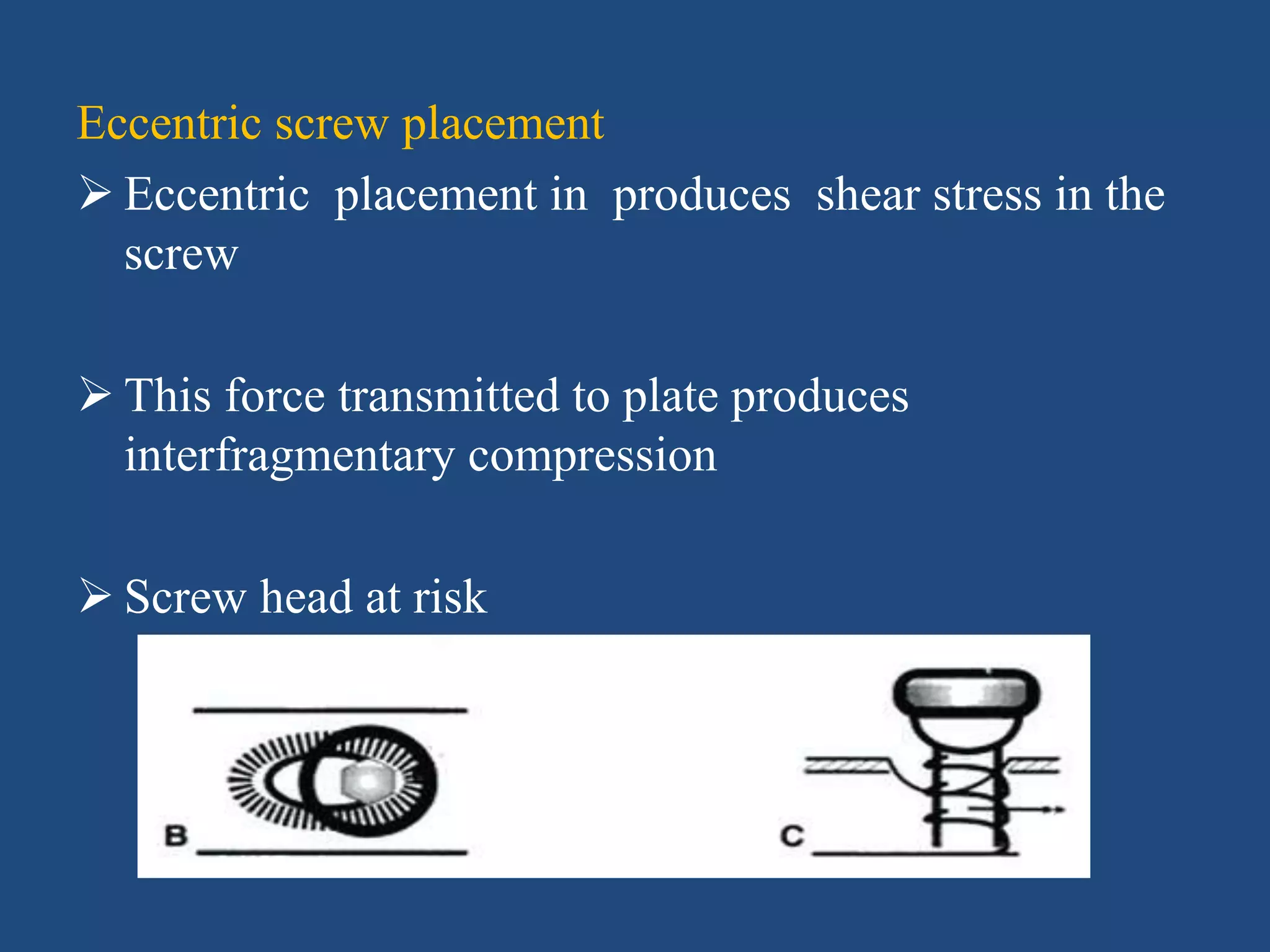 Plating principles in Orthopaedics | PPTX