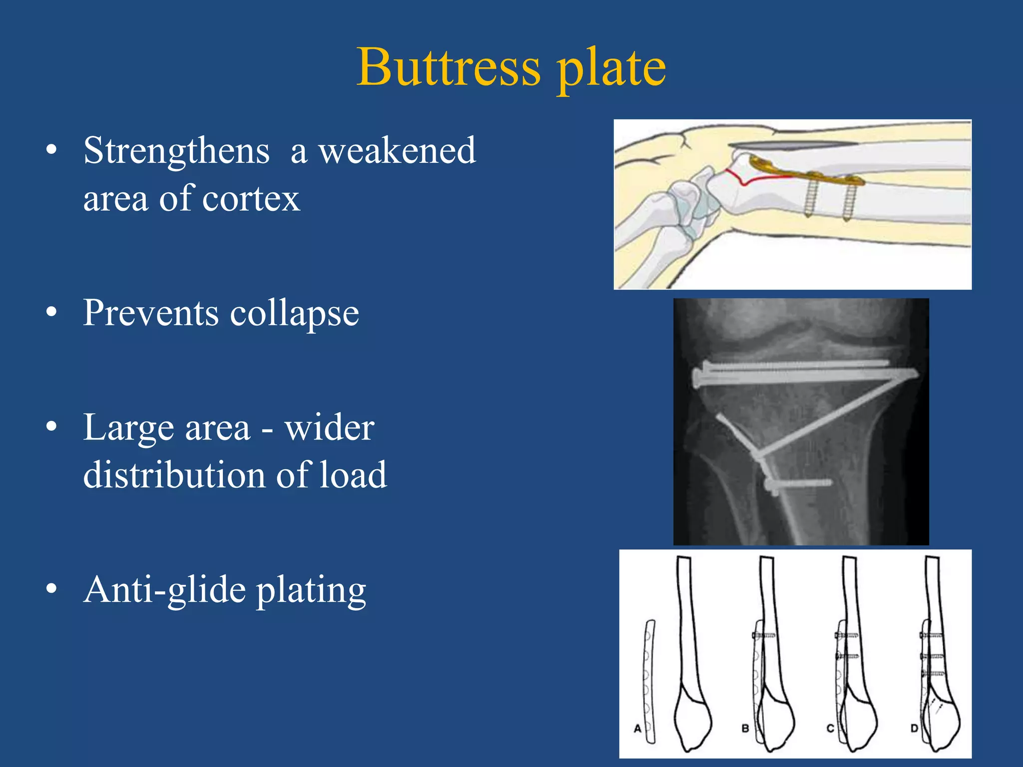Plating principles in Orthopaedics | PPTX