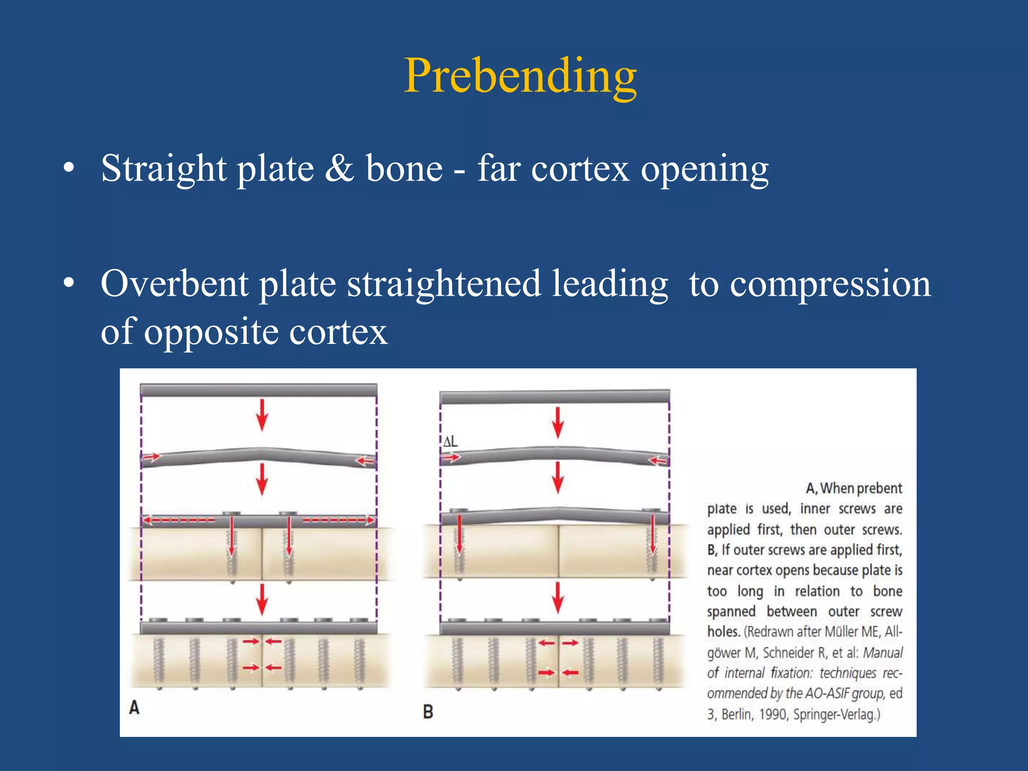 Plating principles in Orthopaedics | PPTX | Death, Injury, or Military ...