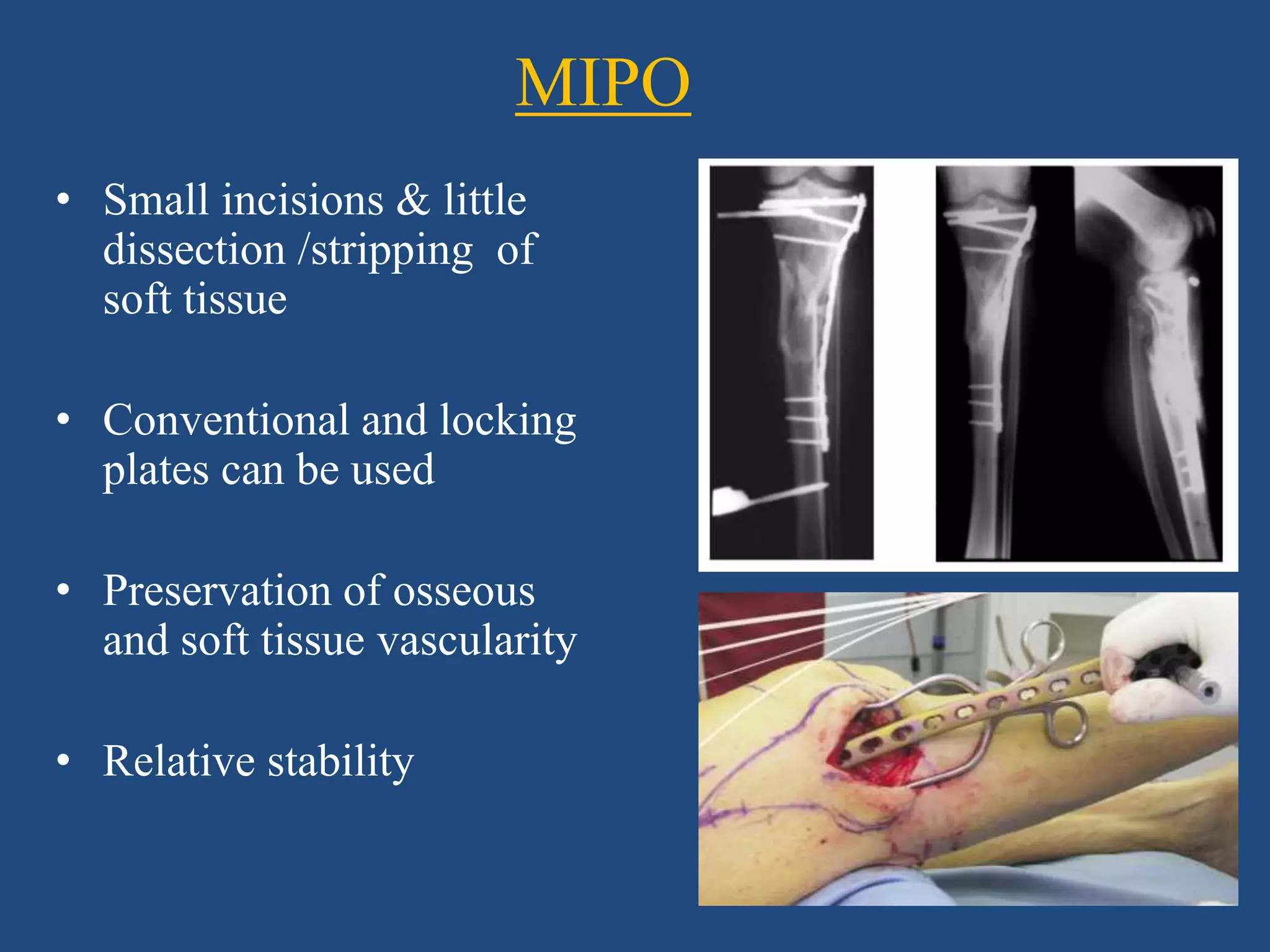 Plating principles in Orthopaedics | PPTX