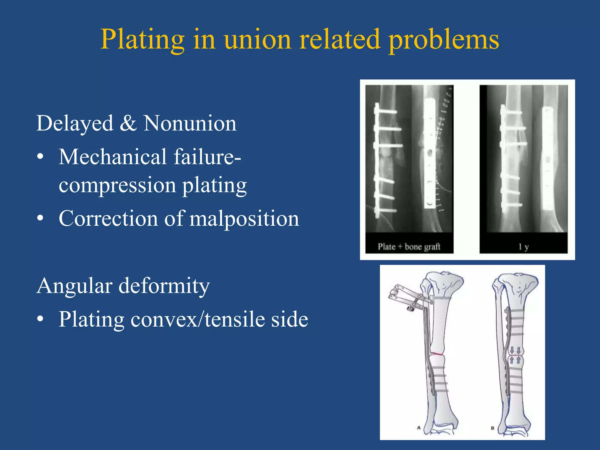 Plating principles in Orthopaedics | PPTX