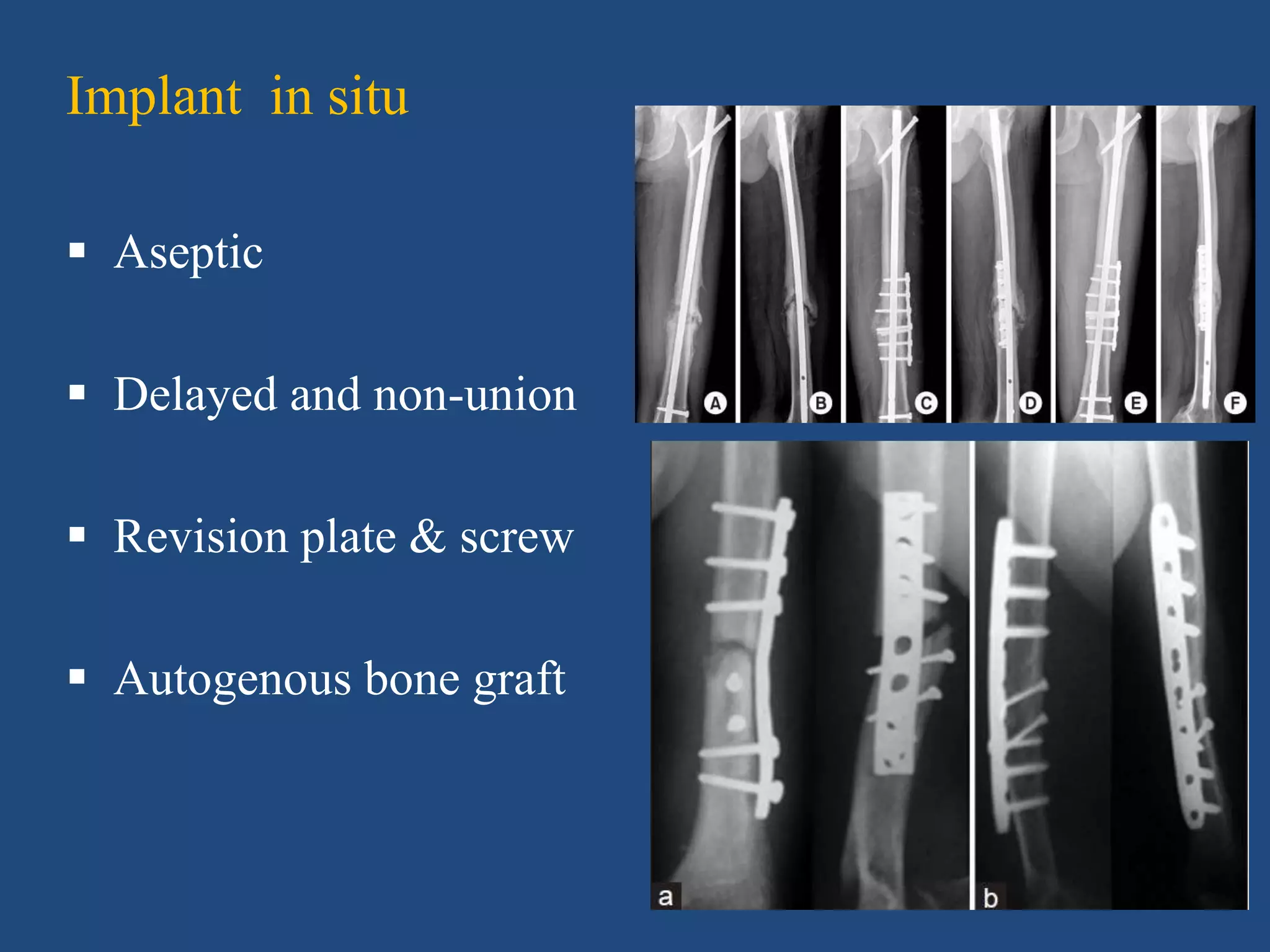 Plating principles in Orthopaedics | PPTX