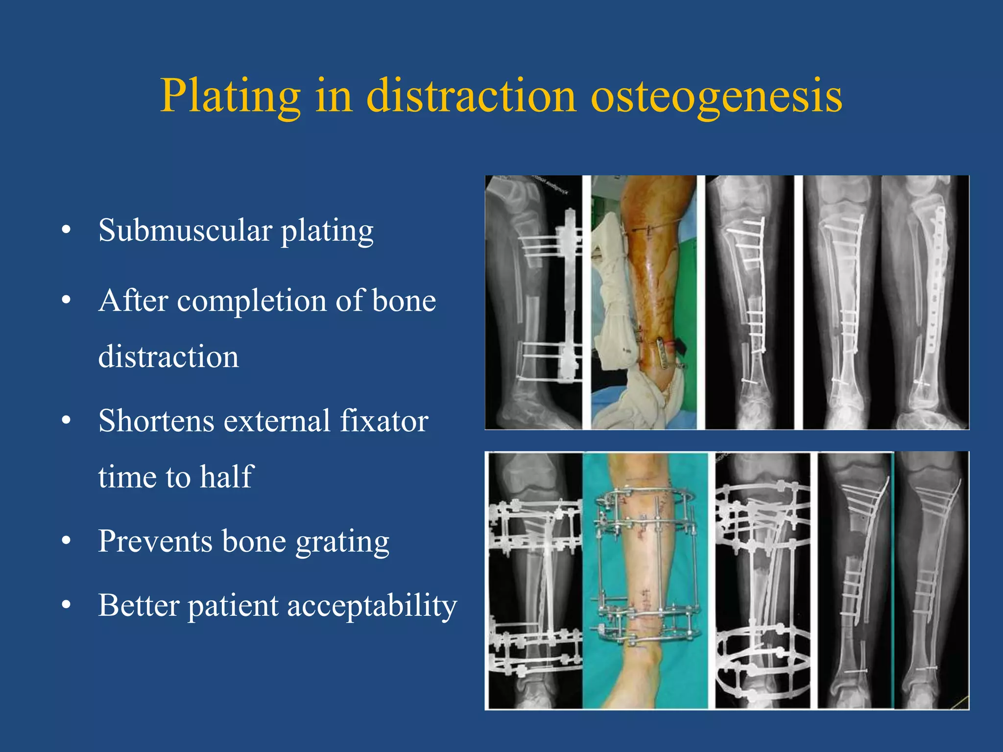 Plating principles in Orthopaedics | PPTX