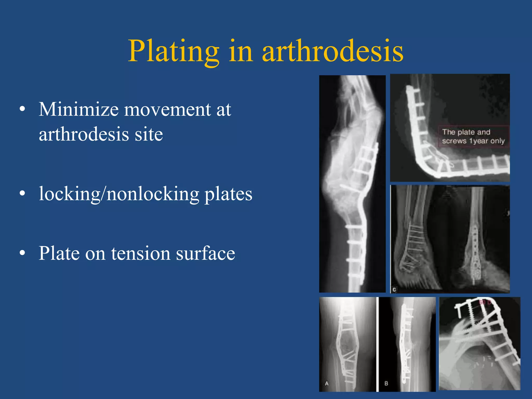 Plating principles in Orthopaedics | PPTX