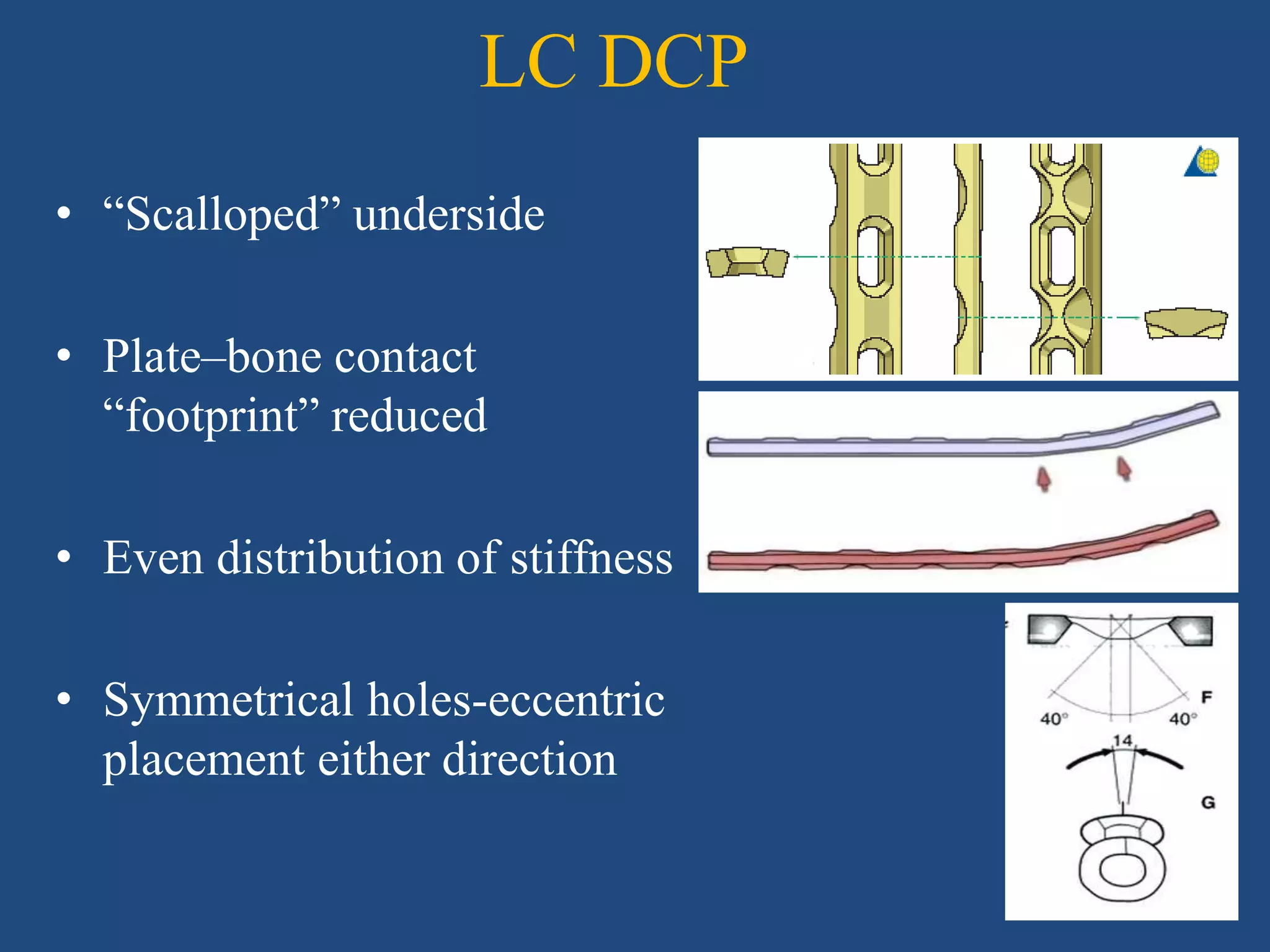 Plating principles in Orthopaedics | PPTX