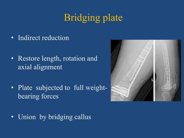 Plating principles in Orthopaedics | PPTX | Death, Injury, or Military ...