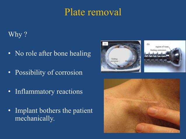 Plating principles in Orthopaedics | PPTX | Death, Injury, or Military ...
