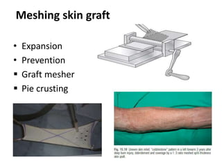 By Dr Dagmawi GeremewGeneral Principles of Skin Graft and Flaps | PPTX