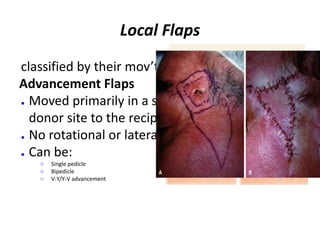 By Dr Dagmawi GeremewGeneral Principles of Skin Graft and Flaps | PPTX