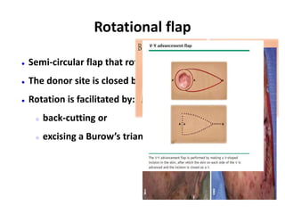 By Dr Dagmawi GeremewGeneral Principles of Skin Graft and Flaps | PPTX