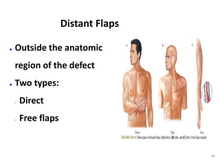 By Dr Dagmawi GeremewGeneral Principles of Skin Graft and Flaps | PPTX
