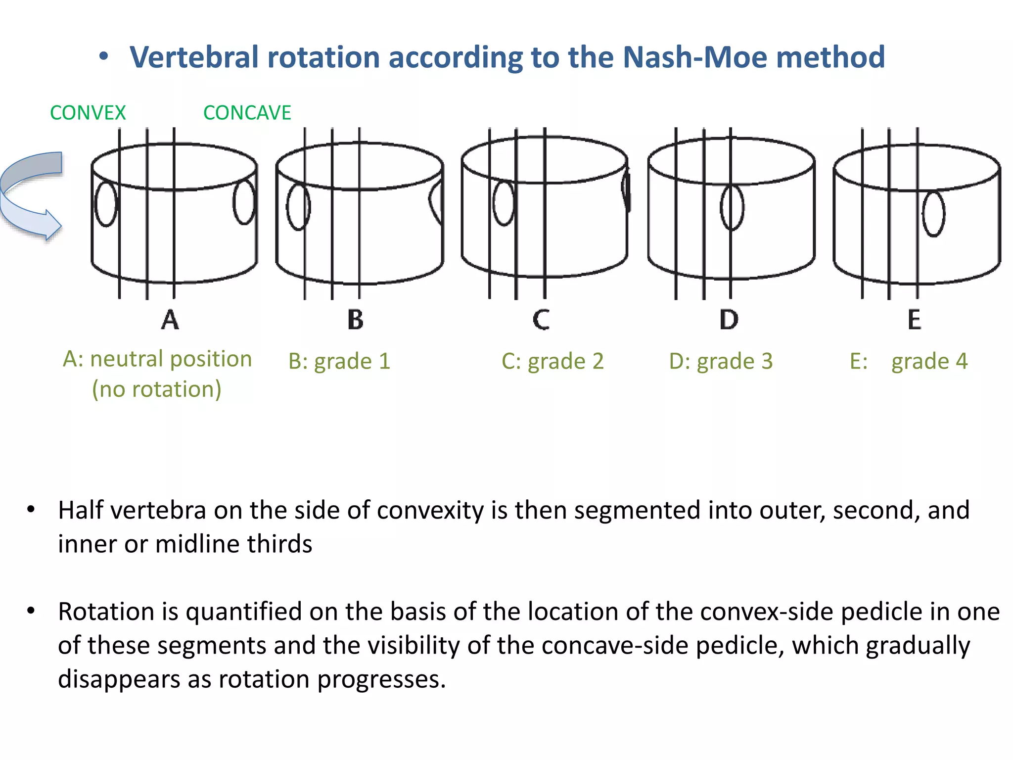 General radiologic measurement of scoliosis 복사본 | PPTX