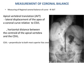 General radiologic measurement of scoliosis 복사본 | PPTX | Death, Injury ...