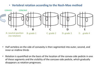 General radiologic measurement of scoliosis 복사본 | PPTX | Death, Injury ...