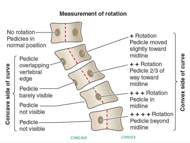 General radiologic measurement of scoliosis 복사본
