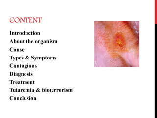 Tularemia | PPTX