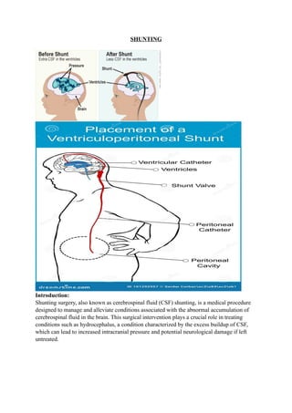 UNIT-II - General surgery NEURO SURGERY | DOCX