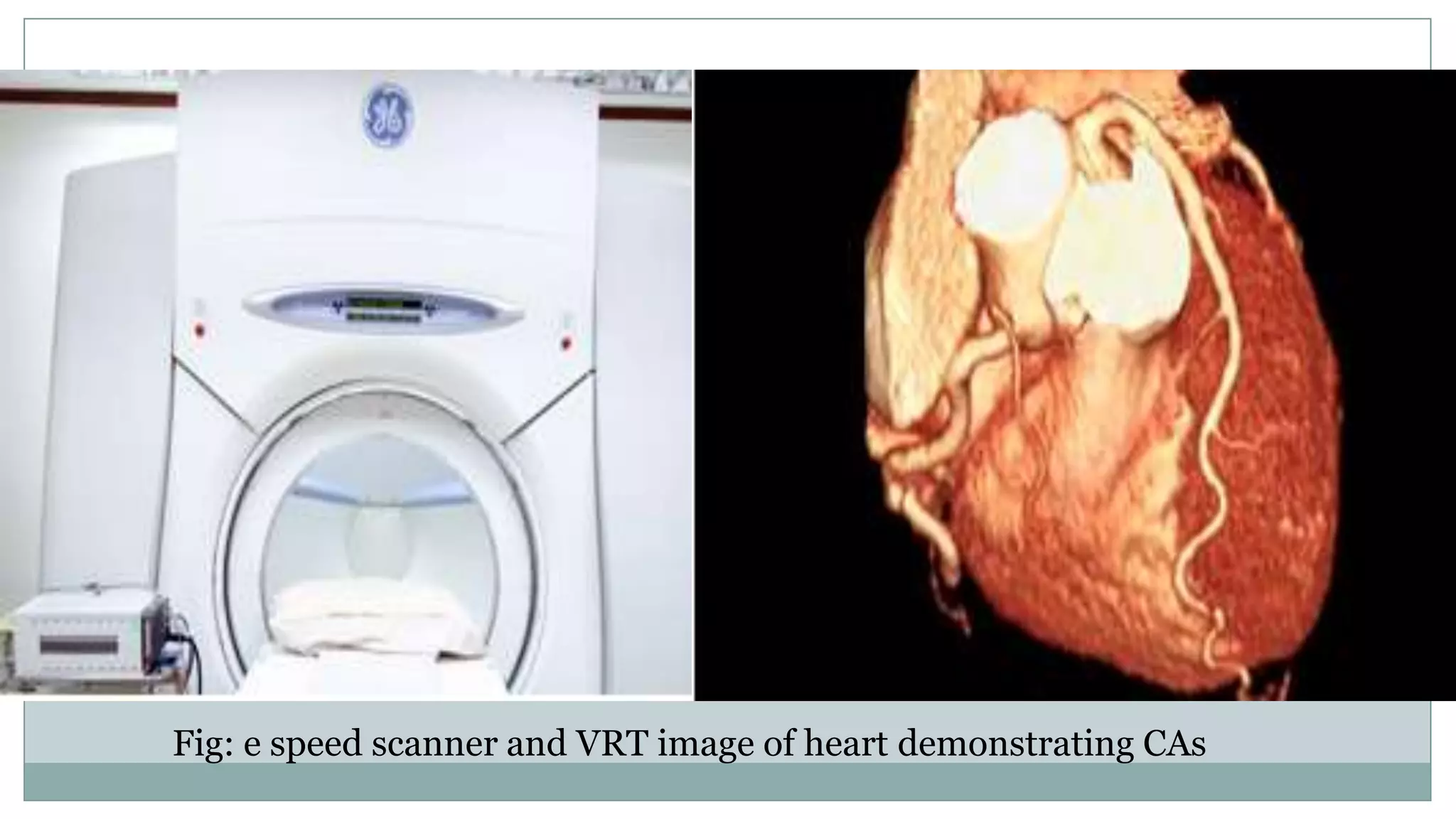 Generations and advancement of CT | PPTX