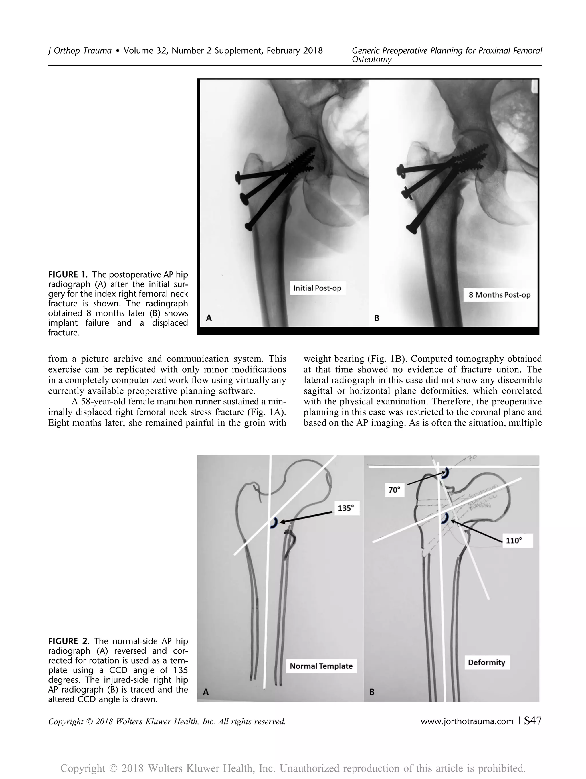 Generic preoperative planning for proximal femoral osteotomy in the ...