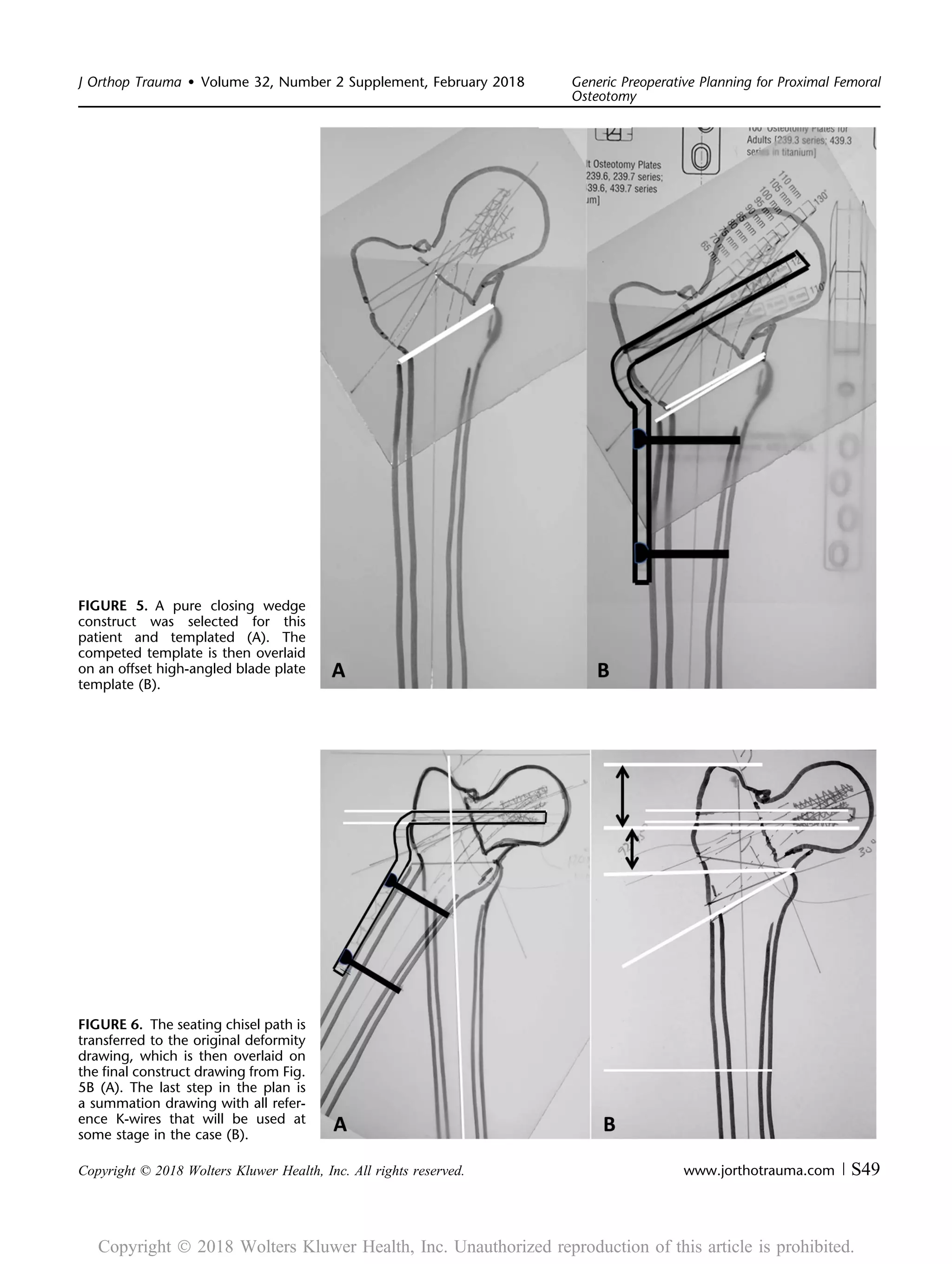 Generic preoperative planning for proximal femoral osteotomy in the ...