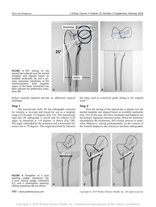 Generic preoperative planning for proximal femoral osteotomy in the ...