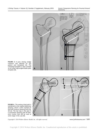 Generic preoperative planning for proximal femoral osteotomy in the ...