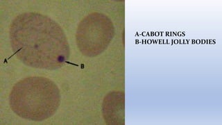 Genesis of Cabot Rings in Blood Abnormalities.pptx