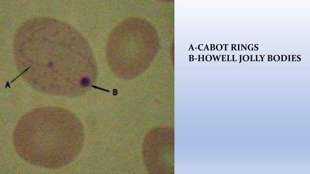 Genesis of Cabot Rings in Blood Abnormalities.pptx