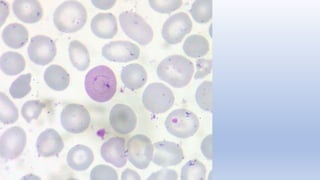 Genesis of Cabot Rings in Blood Abnormalities.pptx