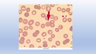 Genesis of Cabot Rings in Blood Abnormalities.pptx